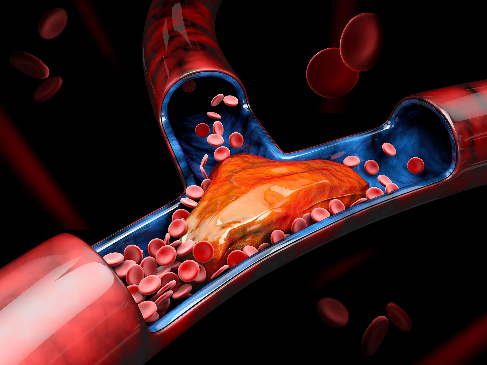 Embolism - Causes, Symptoms and Treatments